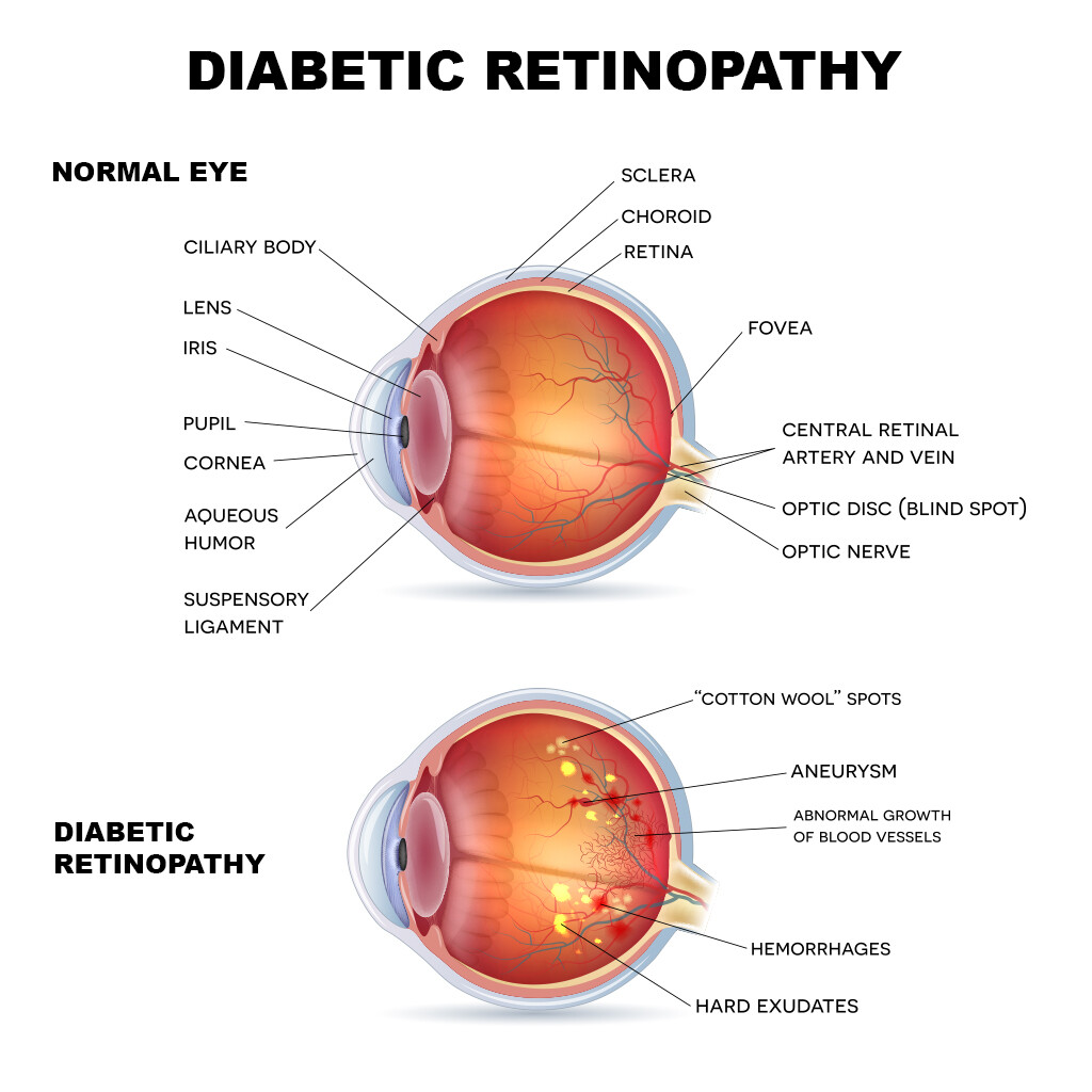 Diabetic Eye Disease | Coastal Eye Surgeons | Ophthalmologists